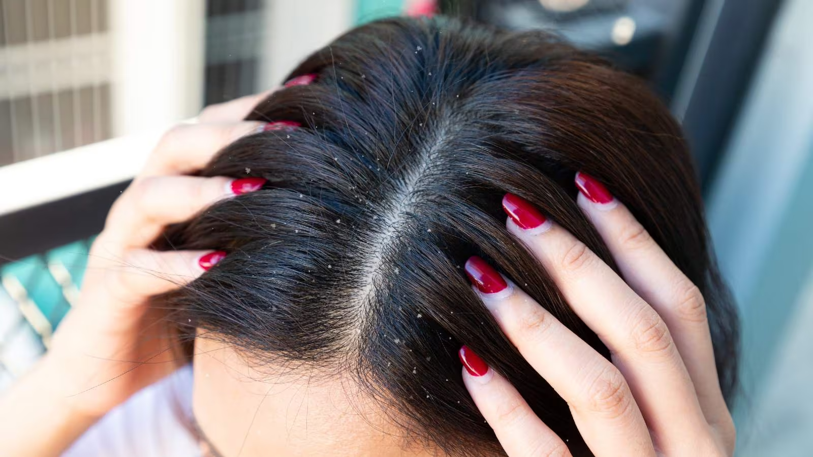WHAT CAUSES DANDRUFF? - Medicoved